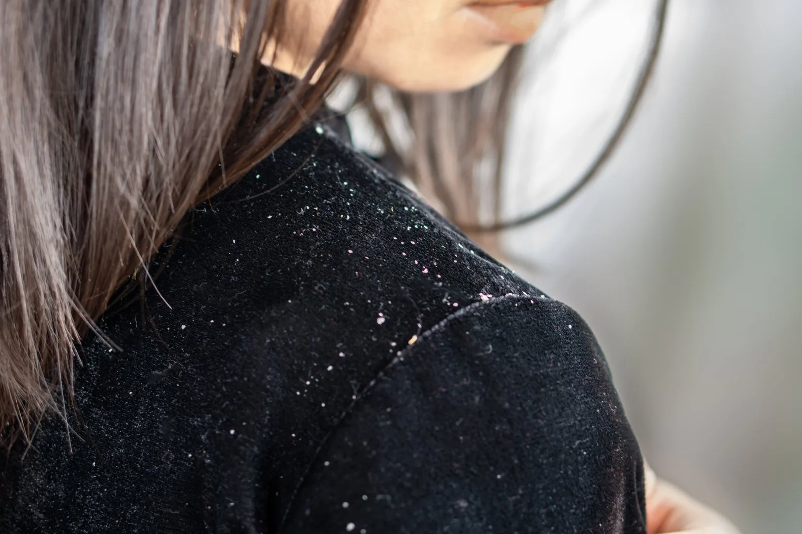 What Is Dandruff & How Is It Treated? - Dr Leonardo® - eHealth Internet ...